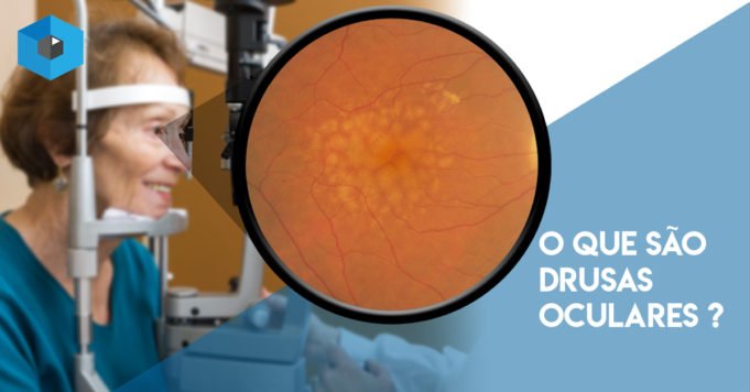 O QUE SÃO DRUSAS E COMO PODEM AFETAR A RETINA? | Retina Curitiba ...